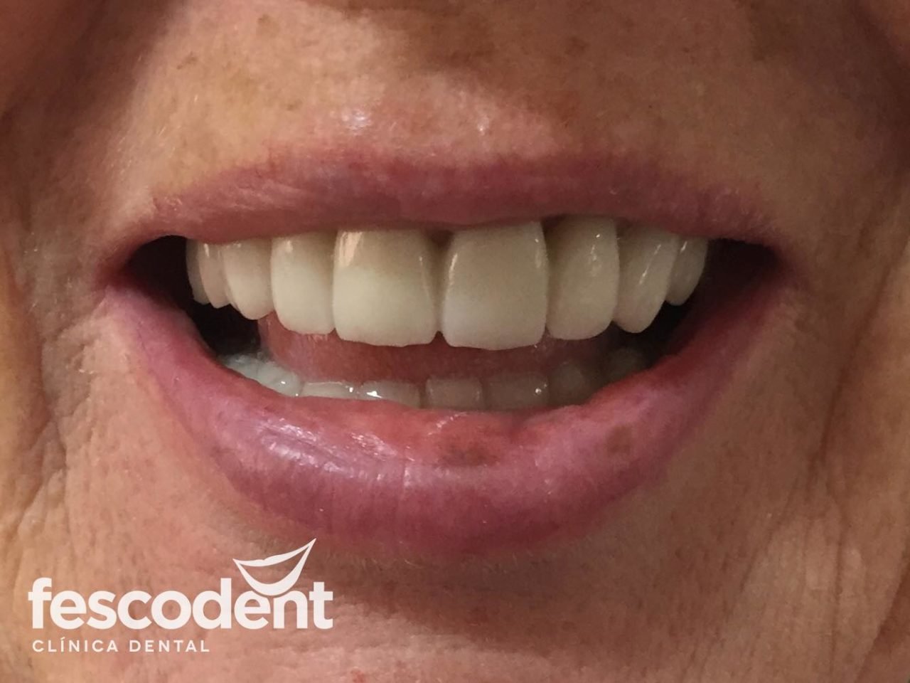 Fixed and Removal Dentures